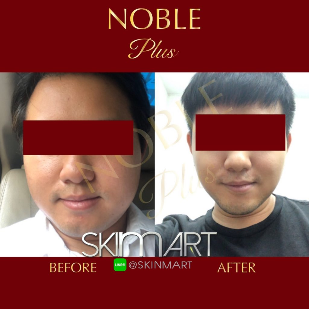 NOBLE Plus 1ขวด – SKINMART